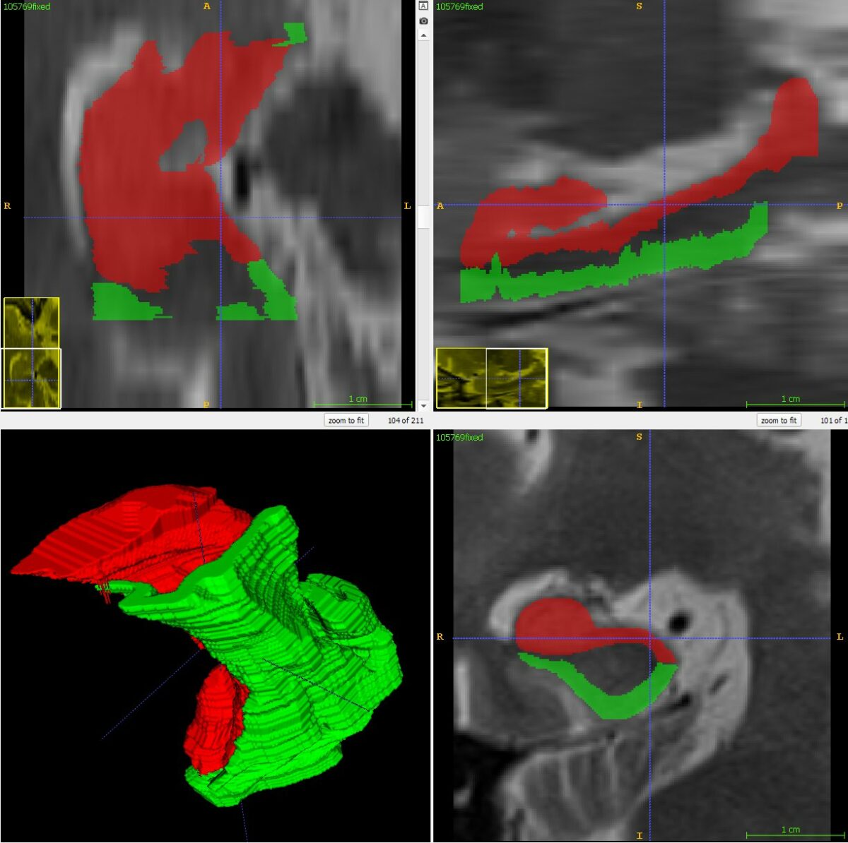 New ITK-SNAP Features Improve Segmentation