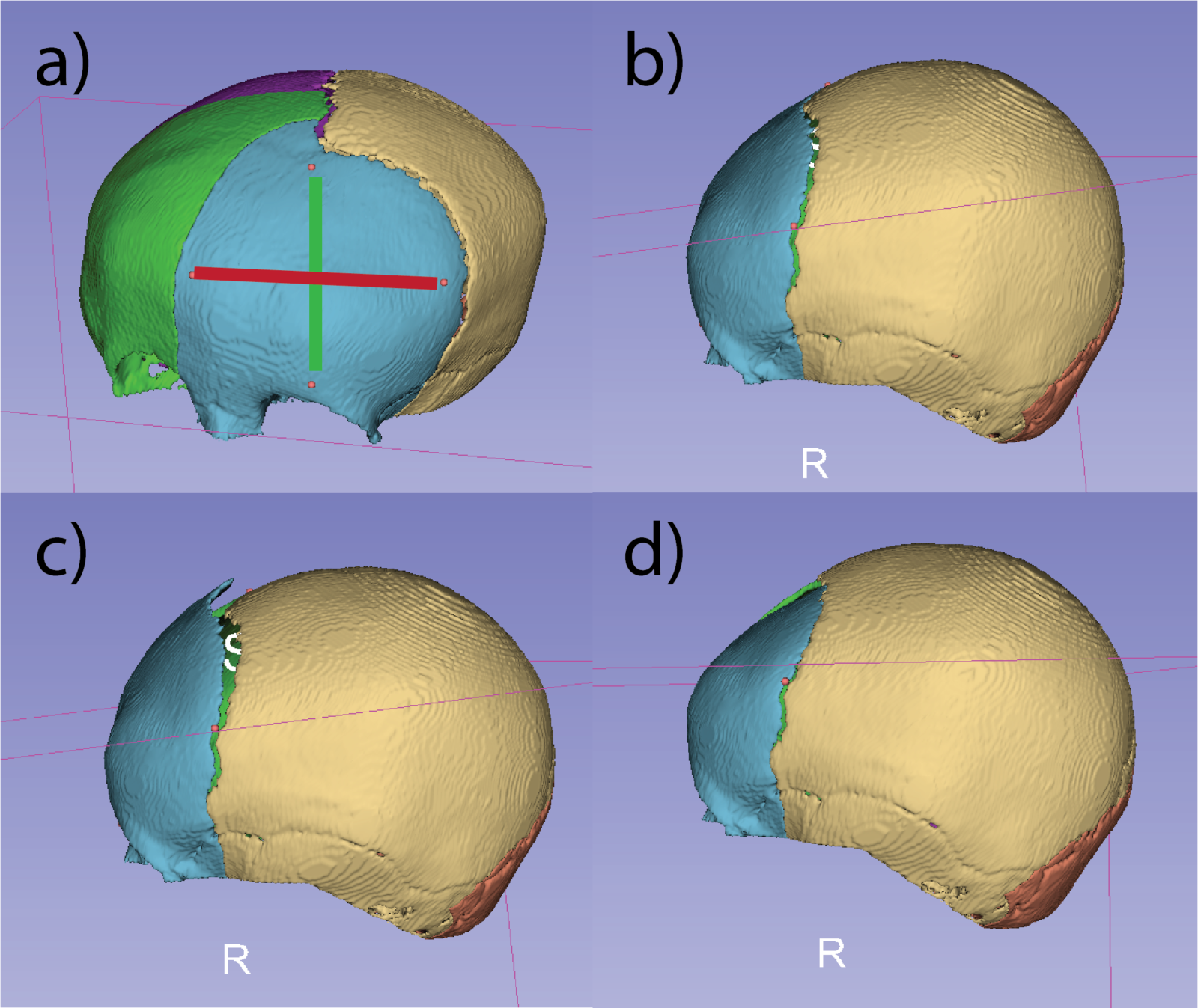 Introducing Osteotomy Planner: A 3D Slicer extension module to simulate ...