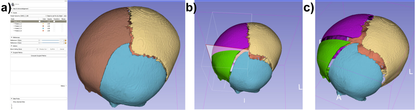 Introducing Osteotomy Planner: A 3D Slicer extension module to simulate ...