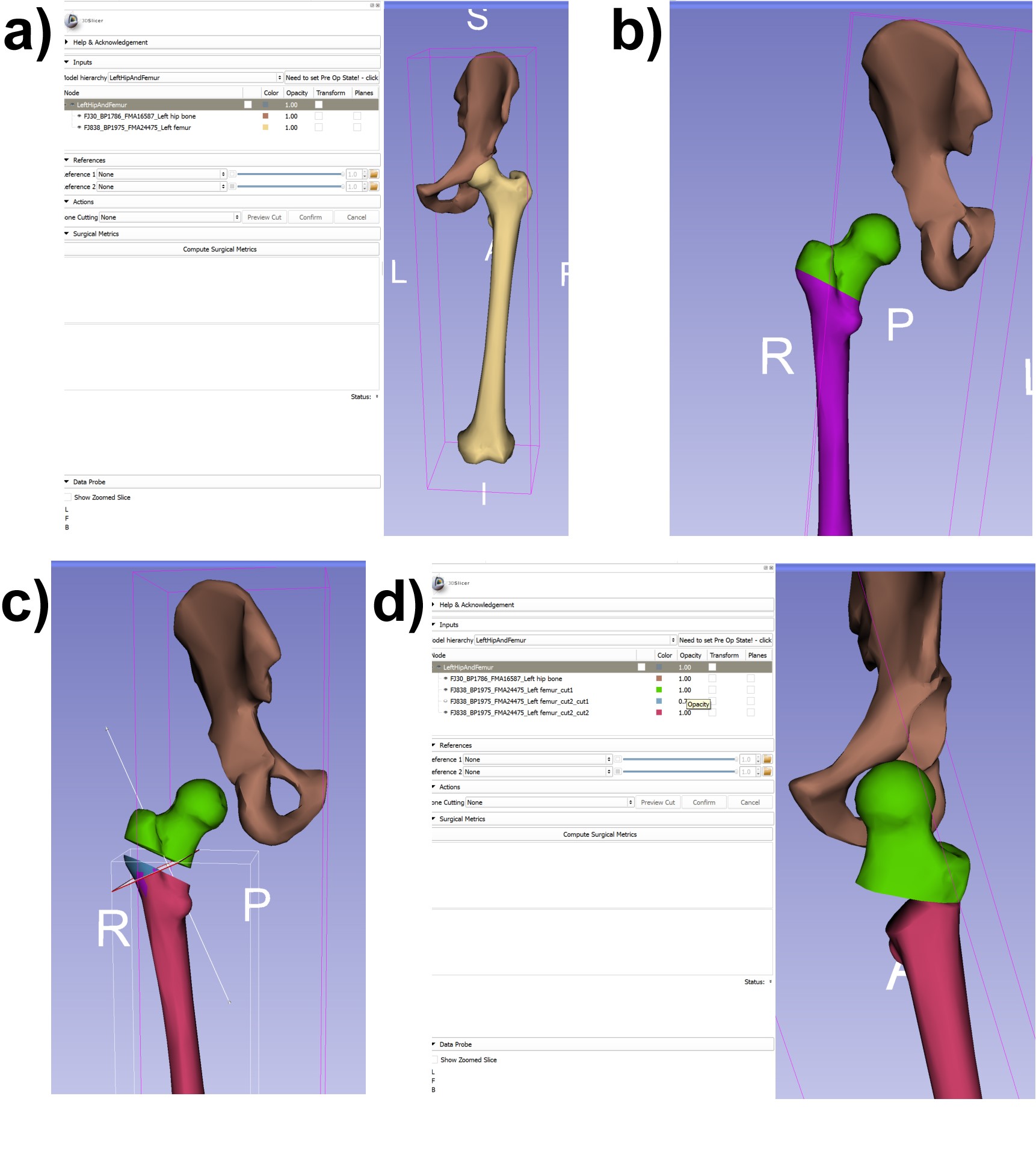 Introducing Osteotomy Planner: A 3D Slicer extension module to simulate ...