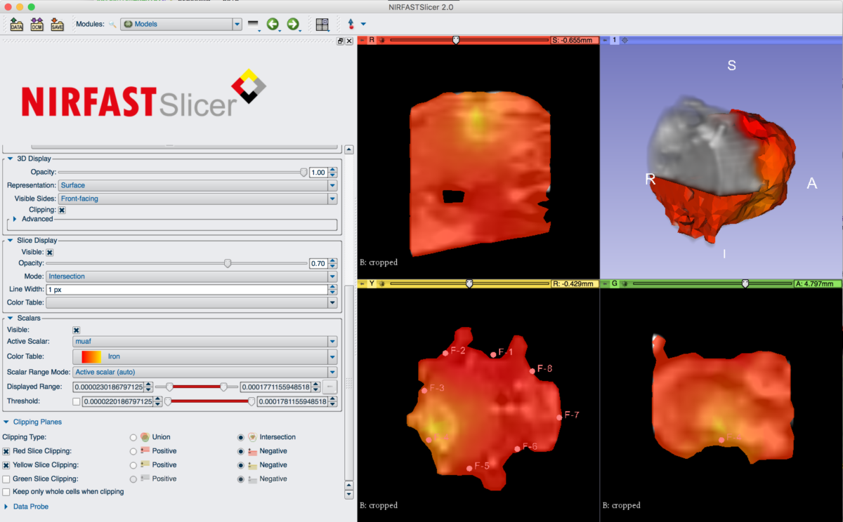 Advancing Optics in Medicine: NIRFAST-Slicer 2.0 and NIRFAST Workshop