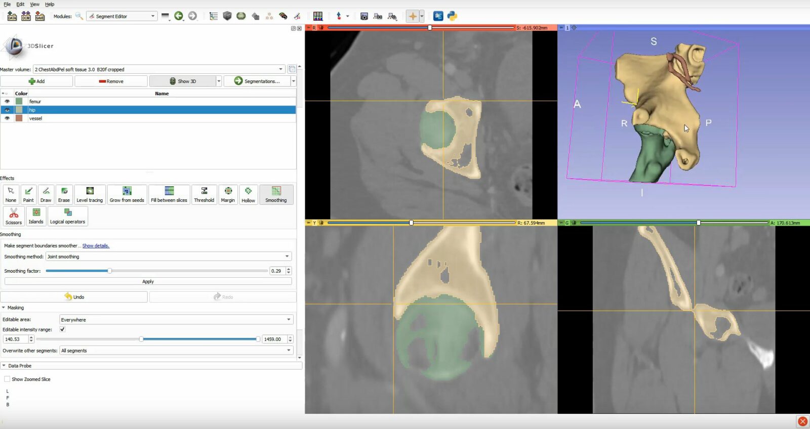 3D Slicer 4.10.1 Improves Segmentation Effects and Adds Video Management Infrastructure