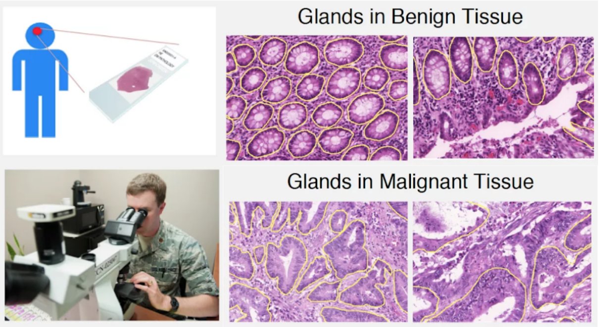 Diagnosis Of Adenocarcinomas In Histology Images Using Persistence