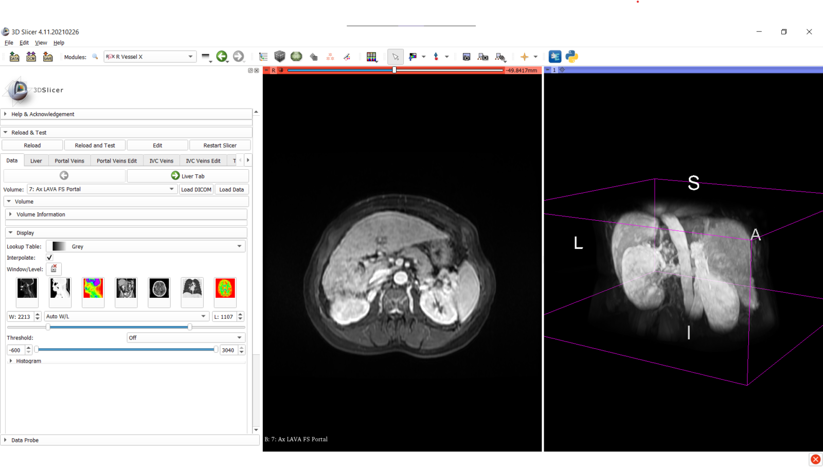 SlicerRVXLiverSegmentation: 3D Slicer extension for interactive liver anatomy segmentation