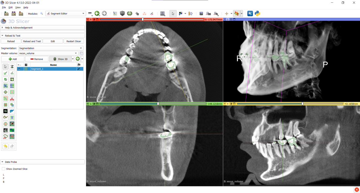 CT reconstruction using Slicer and RTK