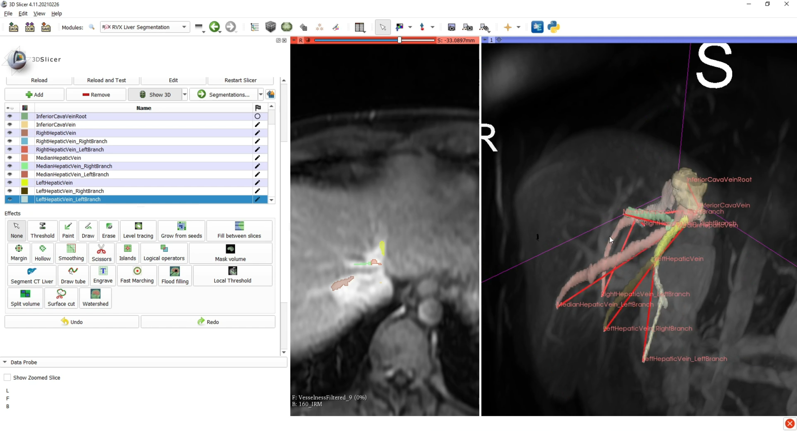 SlicerRVXLiverSegmentation: 3D Slicer extension for interactive liver ...