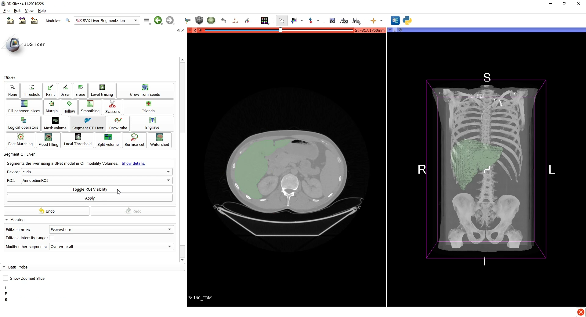 SlicerRVXLiverSegmentation: 3D Slicer extension for interactive liver ...