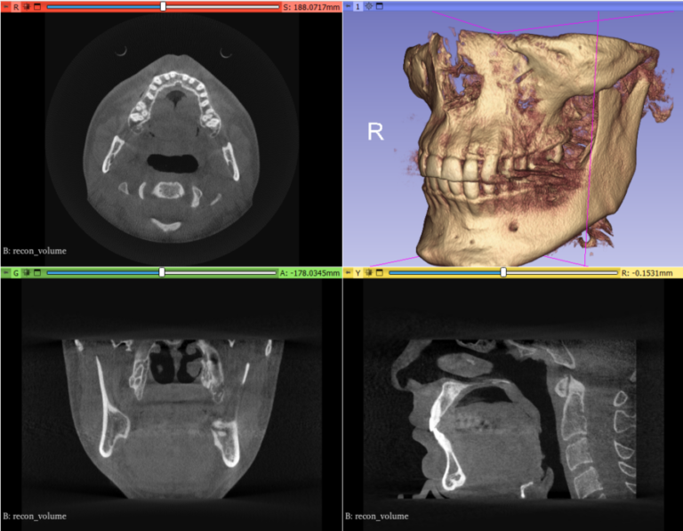 CT reconstruction using Slicer and RTK