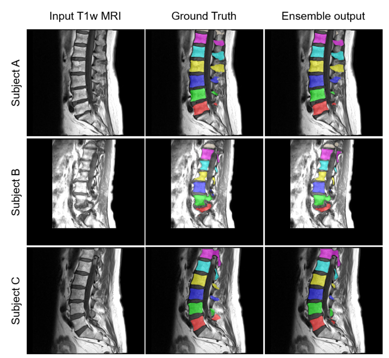 Developing custom 3D medical image segmentation solutions using out-of ...