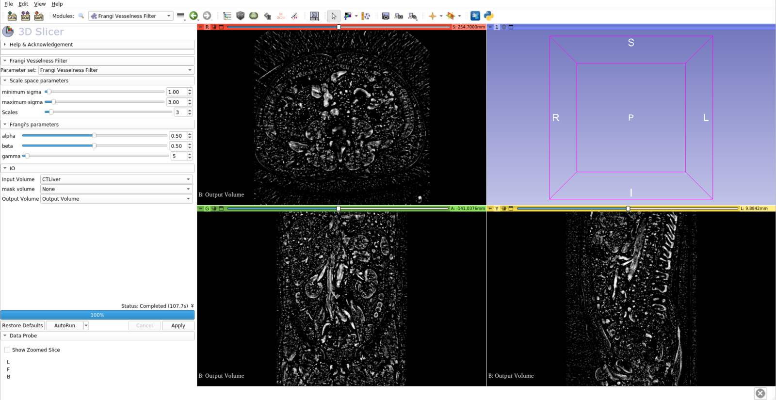 3D Slicer’s Liver Segmentation: A Look at the New Features