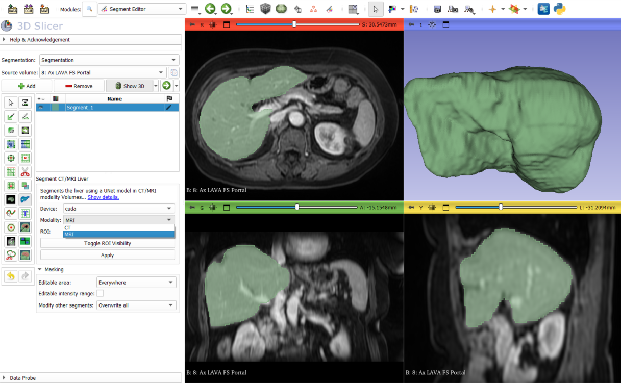 3d Slicers Liver Segmentation A Look At The New Features