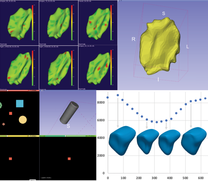 Discovering High-Dimensional Biomarkers Using Statistical Shape Analysis