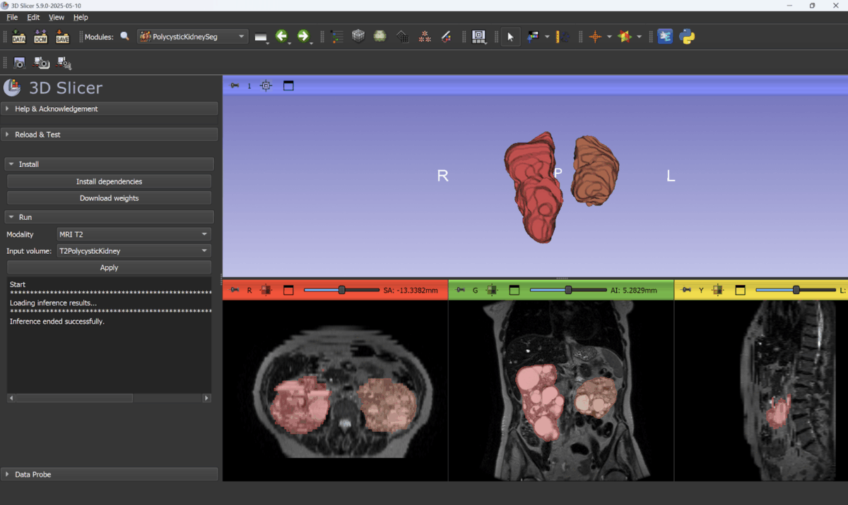 Introducing the 3D Slicer PolycysticKidneySeg Extension