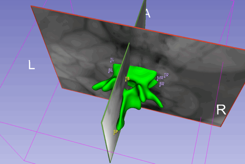 2D to 3D Reconstruction in Medical Imaging : Challenges and Solutions