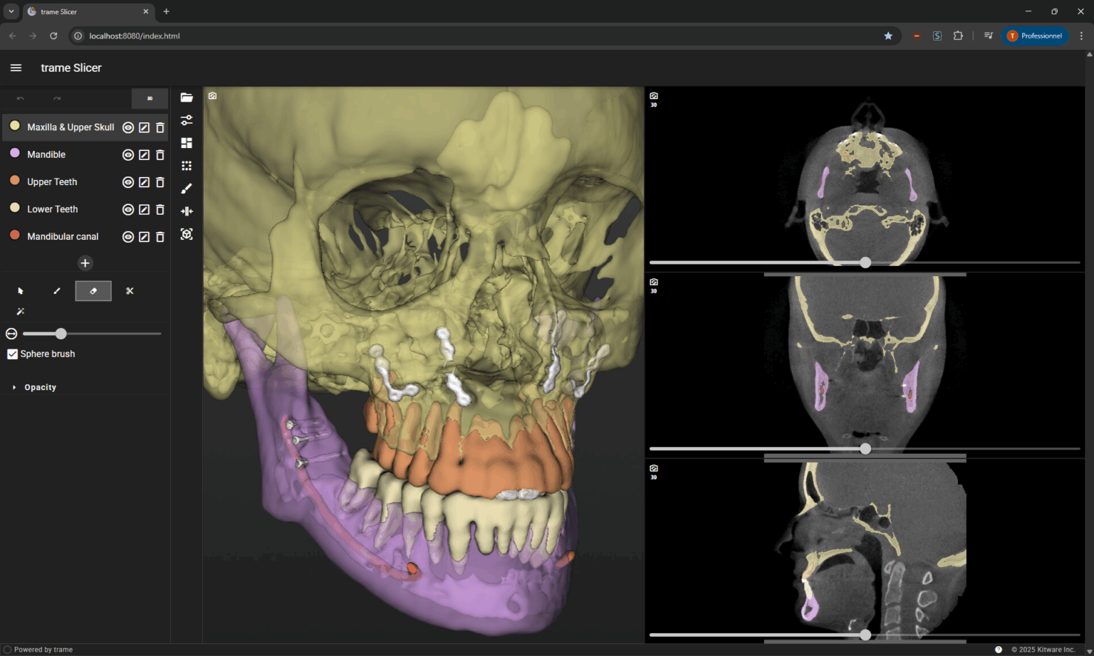 trame-slicer: Bringing the power of 3D Slicer to the web